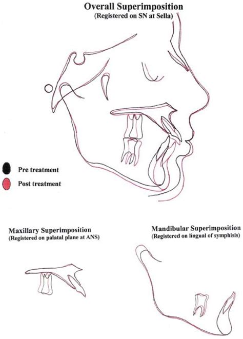 Treatment Effects Of The Mandibular Anterior Repositioning Appliance On