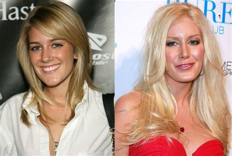 Heidi Montag Before And After Regrets Cosmetic Plastic Surgery