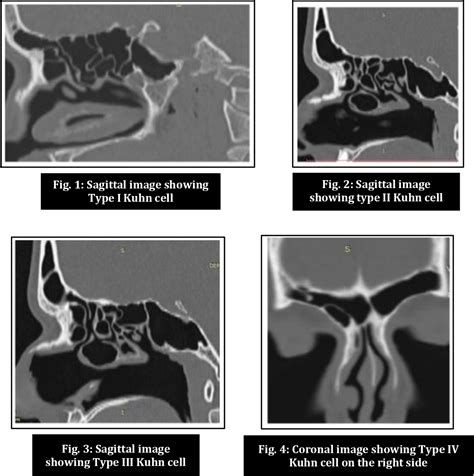 Figure 2 From Normal Variants Of Paranasal Sinuses And Their Clinical
