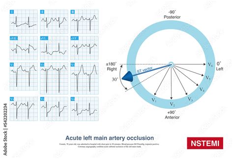 When Extensive St Segment Depression Occurs The Most Important