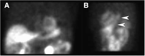 Artifacts And Pitfalls In Myocardial Perfusion Imaging Journal Of