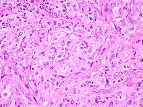 Pathology Outlines Histiocytic Sarcoma