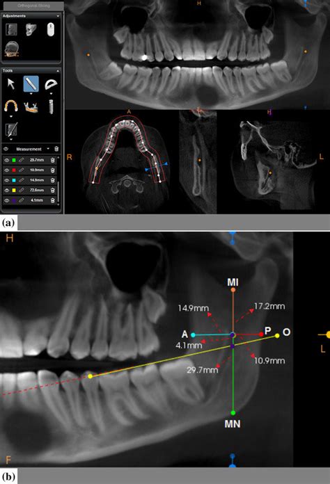 A Reconstructed Axial Cross Sectional Sagittal And Panoramic
