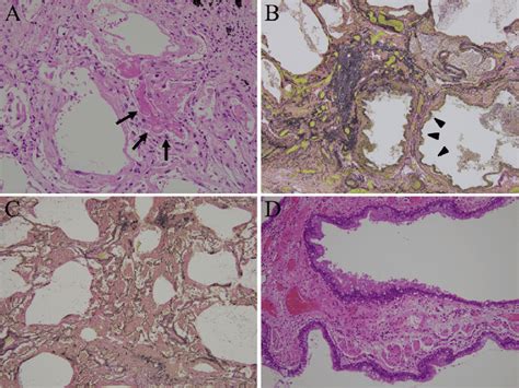 Pathological Findings At Autopsy A Hematoxylin And Eosin Staining