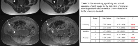 A Patient With Active Crohns Disease Involving Cecum And Terminal