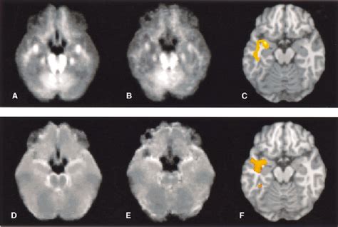 Left Temporal Lobe Epilepsy Group With Normal Conventional Mri A And