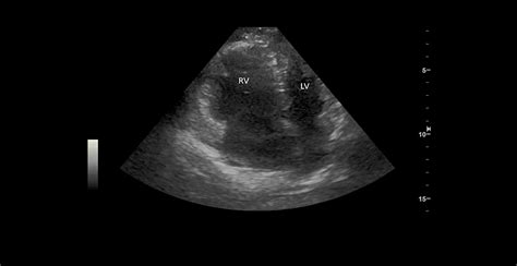 Bradycardia As A Rare Sign Of Pulmonary Embolism A Case Report Of
