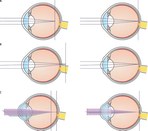 Refractive Surgery The Lancet