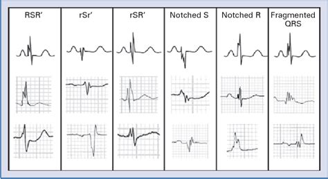 Qrs Fragmentation Diagnostic And Prognostic Significance Semantic