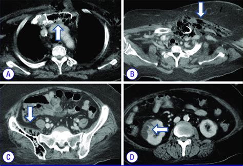 Chest And Abdominal Computed Tomography Ct Scan At Admission Showed