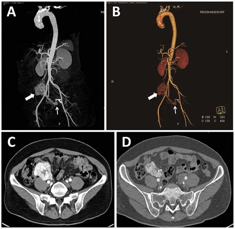 A Rare Case Of Extra Adrenal Pheochromocytoma Localized To The Ovary