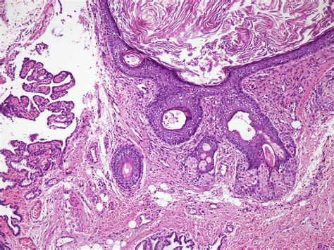 Pathology Outlines Germ Cell Tumors