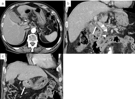 Contrast Enhanced Computed Tomography Findings A Swelling And