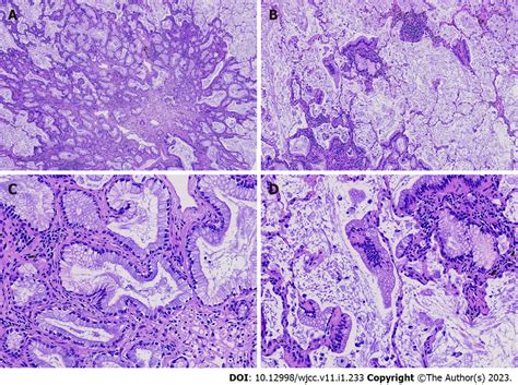 Hematoxylin And Eosin Staining Of The Mucinous Adenocarcinoma Area A