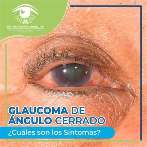 Glaucoma De ángulo Cerrado