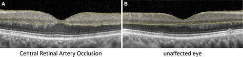 Frontiers Inner Retinal Layer Hyperreflectivity Is An Early Biomarker