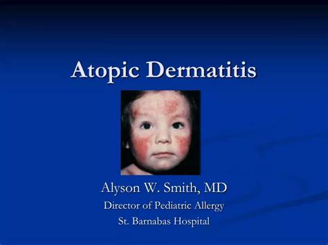 Ppt Atopic Dermatitis Powerpoint Presentation Free Download Id 634155