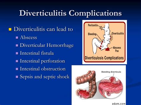 Diverticulitis Causes Signs Symptoms And Treatment Medicus My Xxx Hot
