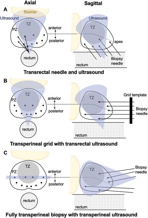 A Novel Magnetic Resonance Imaging Ultrasound Fusion Prostate Biopsy