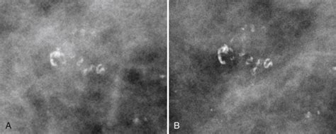 Mammographic Analysis Of Breast Calcifications Clinical Tree