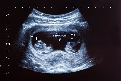 Grossesse Gémellaire Ce Quil Faut Savoir Quand On Est Enceinte De