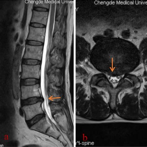 Lumbar Mri In Case 1 A Sagittal Mri Shows L4 5 Intervertebral Disc