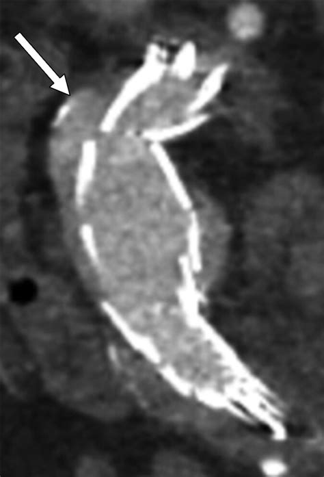 Best Practice Guidelines Imaging Surveillance After Endovascular