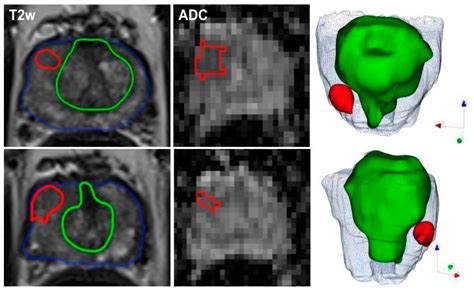 Cancers Free Full Text Multiparametric Mri For Prostate Cancer