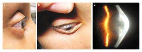 Keratoconus Complicated By Acute Corneal Hydrops Nejm