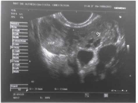 Unruptured Ovarian Ectopic Pregnancy In Adolescence Auctores