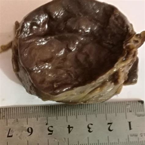 Macroscopic Appearance Of The Mass With Smooth Outer Surface And