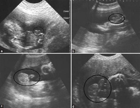 The Accuracy Of 2d Ultrasound Prenatal Sex Determination Scienceopen