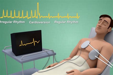 Cardioversión Eléctrica Dr Yitzar Bañuelos Millán