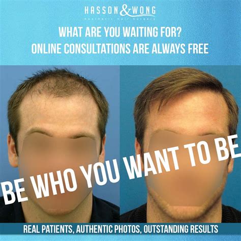 The Ultimate Guide To Hair Transplant Cost In Virginia Martlabpro