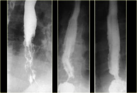 Esophageal Varices X Ray