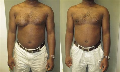 Gynecomastia — Symptoms And Treatment Online Medical Library