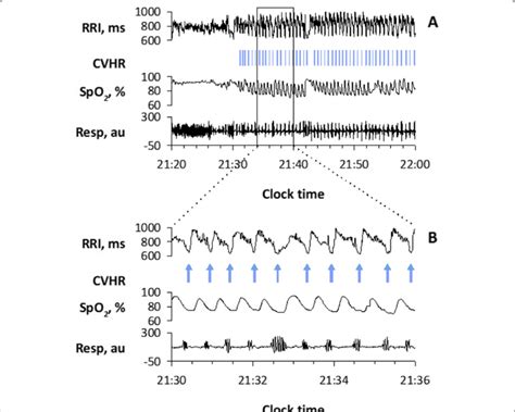 Cyclic Variation Of Heart Rate Cvhr Detected By The Autocorrelated