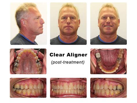 Crossbite Braces Before After
