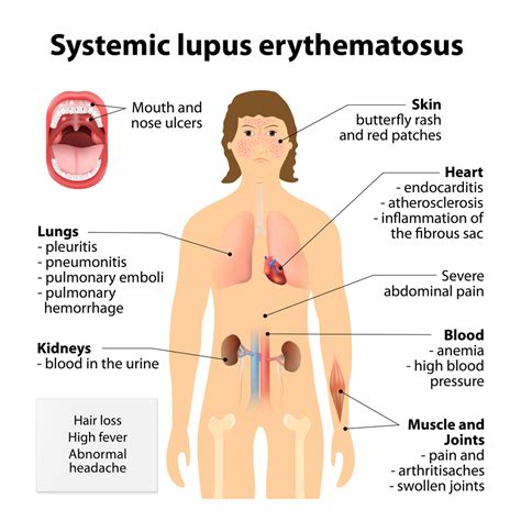 Systemic Lupus Erythematosus Houston Tx Rheumatology And Infectious