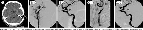 Figure 1 From Multiple Ruptured Cerebral Aneurysms As A Presenting