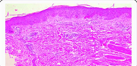 Hematoxylin And Eosin Stained Section Showing Mild Hyperkeratosis With