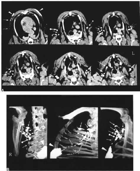 Sentinel Lymph Node Biopsy In Breast Cancer Guided By Ct Lymphography