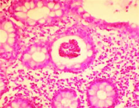 Rectal Biopsy Showing Crypt Abscess And Diffuse Lymphoplasmacytic