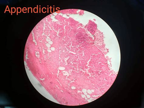 Acute Appendicitis Pathogenesis Morphology Complications Notesmed