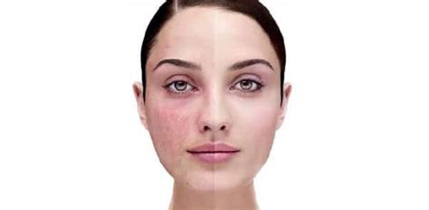 How To Reduce Redness On Face In 5 Easy Steps