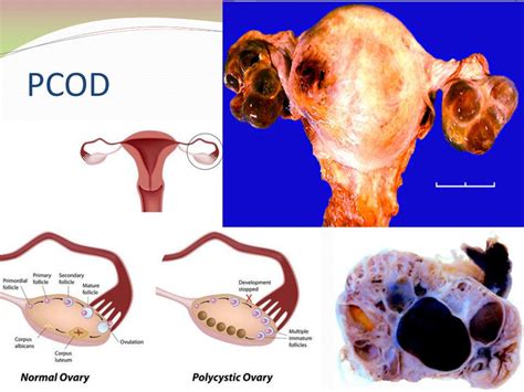 Ppt Polycystic Ovarian Disease And Endometriosis Powerpoint