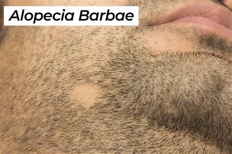 Alopecia Barbae Signs Symptoms And Treatment Bald And Beards