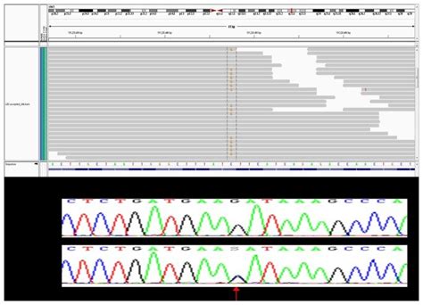 Sanger Sequence Validation Of Highly Expressed Novel Somatic Snvs For