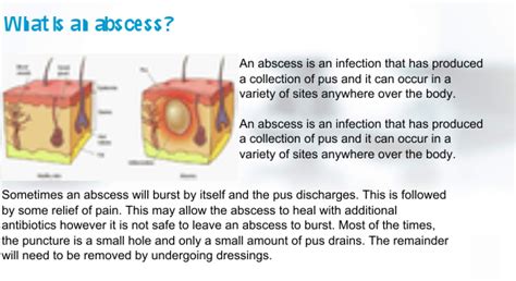 Anal Abscess Surgery Treatment In Dubai Abscess Specialist Cosmocare