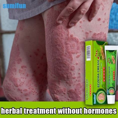 Eczema Cream Ringworm Cream Psoriasis Cream Topical Medication Ubat